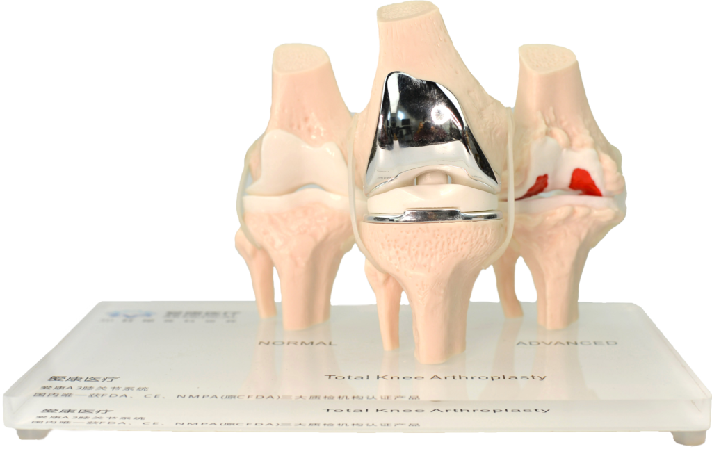 Knee Pathology Demonstration Models - Orthopedic Models | Medical ...